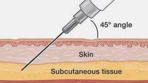 What Size Needle For Vitamin B12 Injection? – AIPAK ENGINEERING